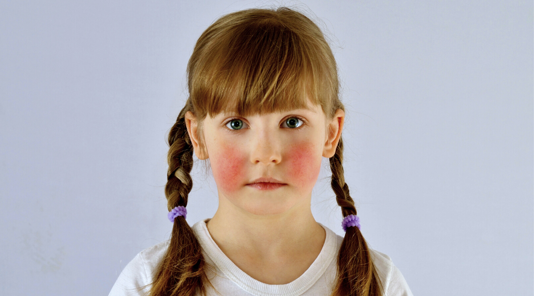 6 Face Skin Problems Among kids and Their Remedies – Skye Monroe